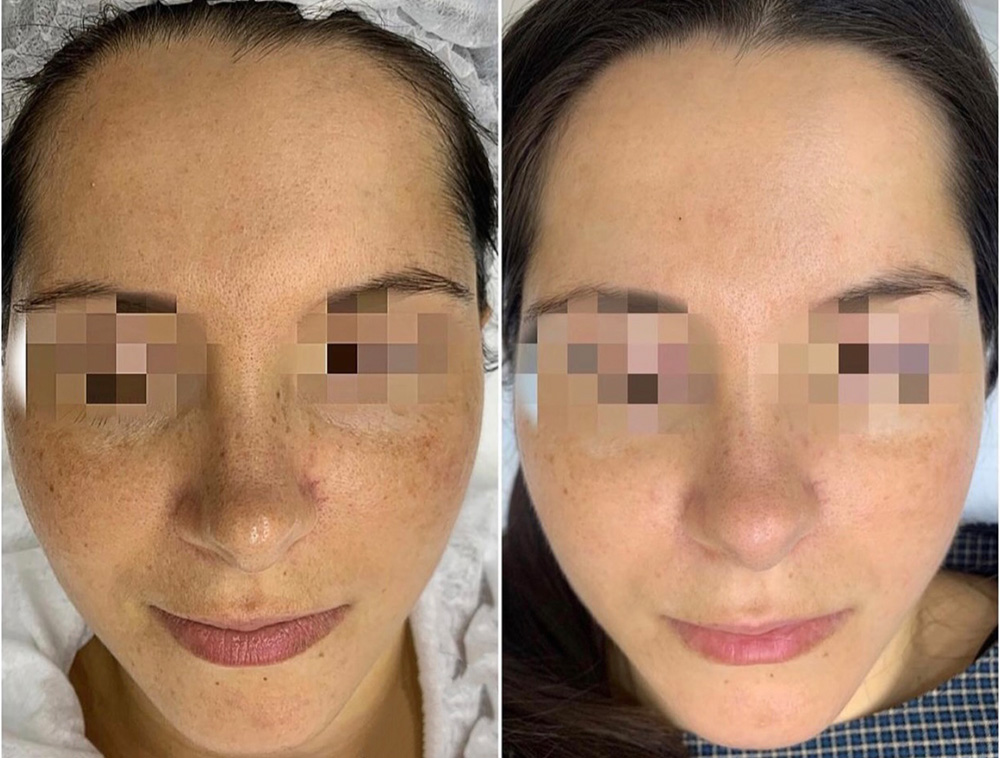 PRX T33 - Wink Medical Aesthetics Wink Medical Aesthetics
